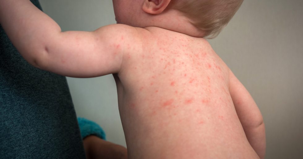 eczéma bébé : Un quart des bébés en France serait touché chaque année ...